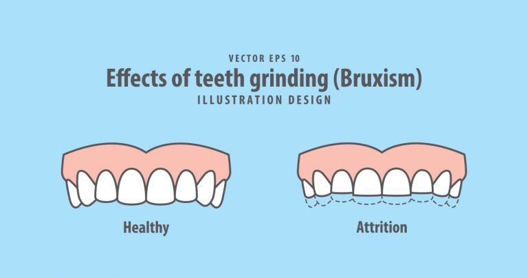 All You Need To Know About Teeth Grinding - Koowerup Dental Surgery